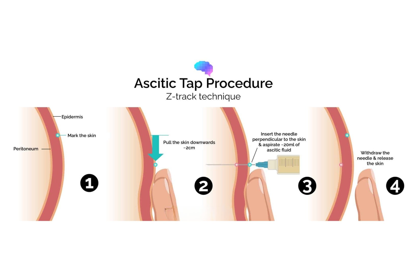 Ascitic Fluid Tapping – Gastro Skin Care Nagpur